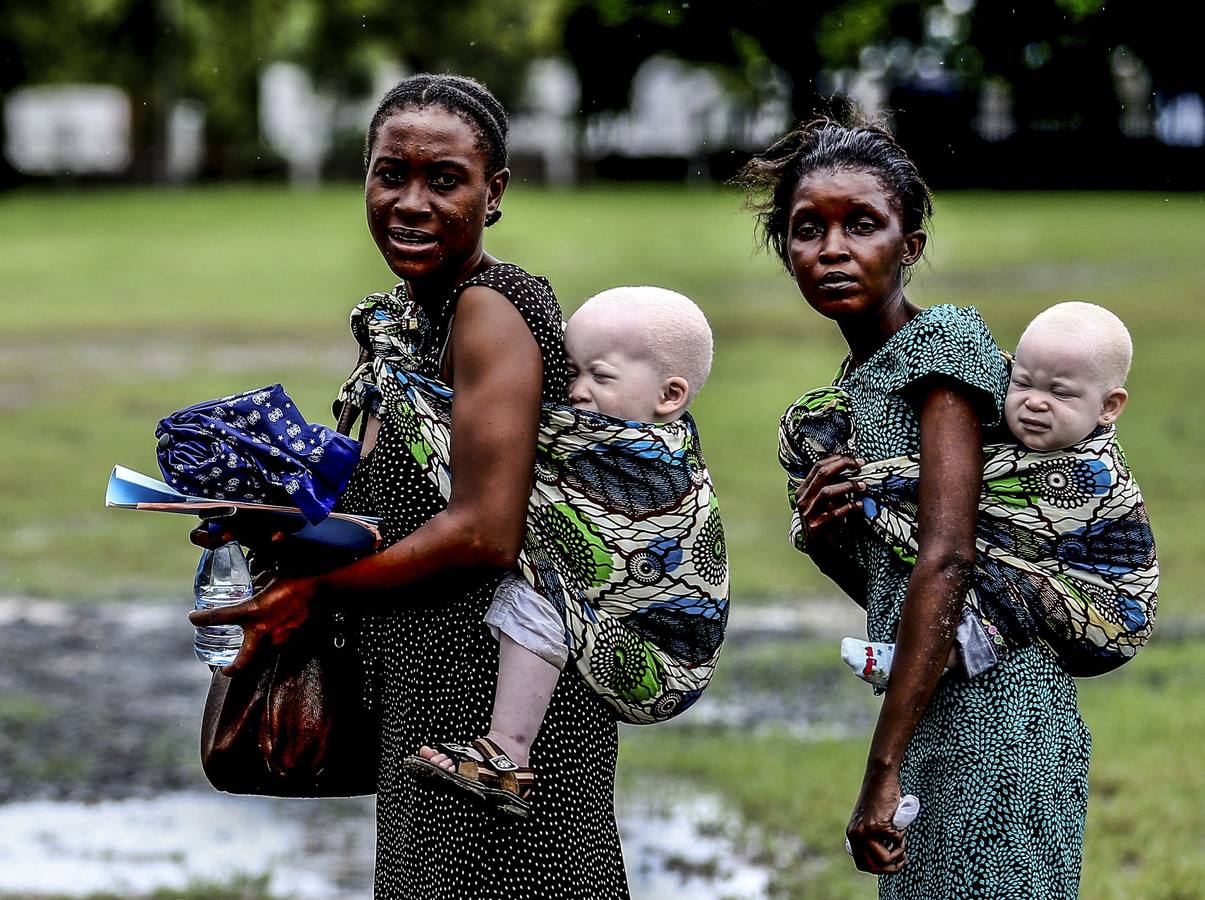El drama de los albinos de Tanzania - diariosur.es